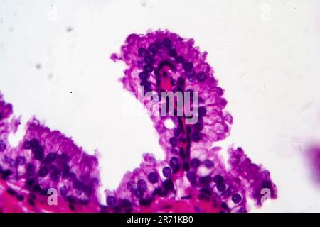Benign prostatic hyperplasia, light micrograph, photo under microscope ...