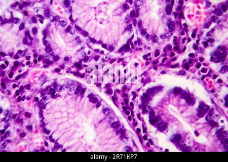 Histopathology of stomach adenocarcinoma, light micrograph, photo under ...