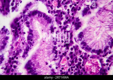 Histopathology of stomach adenocarcinoma, light micrograph, photo under ...