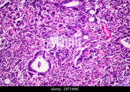 Gastric adenocarcinoma, light micrograph, photo under microscope. High ...