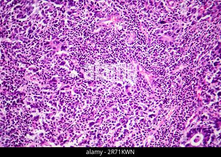 Gastric adenocarcinoma, light micrograph, photo under microscope Stock ...