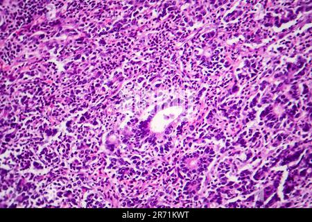 Gastric adenocarcinoma, light micrograph, photo under microscope. High ...