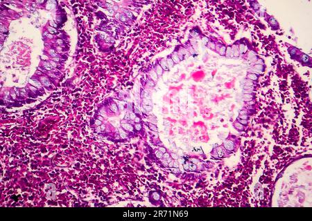 Villous colon adenocarcinoma, light micrograph, photo under microscope ...