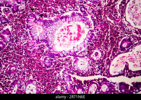 Villous colon adenocarcinoma, light micrograph, photo under microscope ...