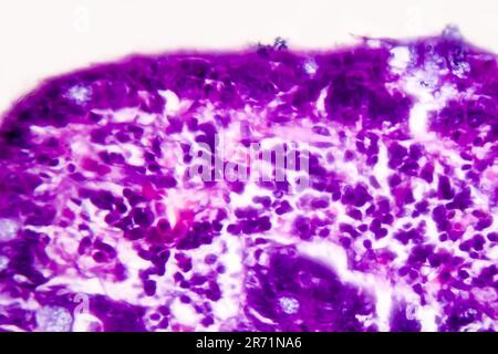 Villous colon adenocarcinoma, light micrograph, photo under microscope ...