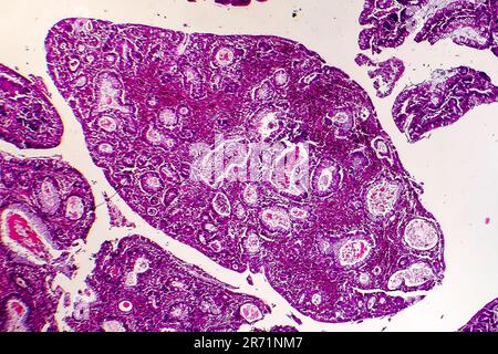 Villous colon adenocarcinoma, light micrograph, photo under microscope ...