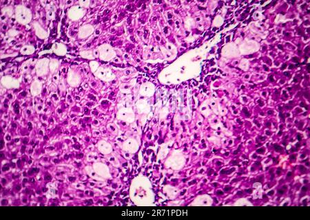 Histopathology of acute hepatitis, light micrograph, photo under ...