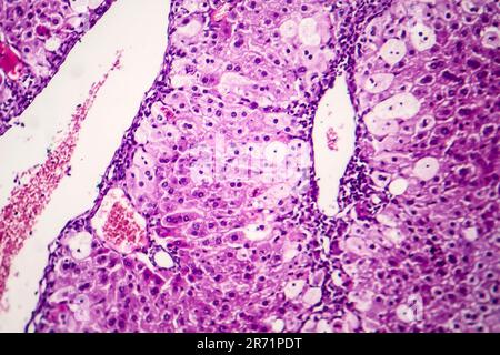 Histopathology of acute hepatitis, light micrograph, photo under ...
