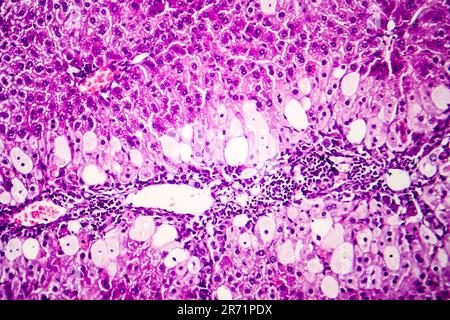 Histopathology of acute hepatitis, light micrograph, photo under ...