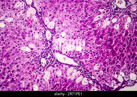 Histopathology of acute hepatitis, light micrograph, photo under ...