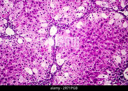 Histopathology of acute hepatitis, light micrograph, photo under ...