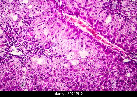 Histopathology of acute hepatitis, light micrograph, photo under ...