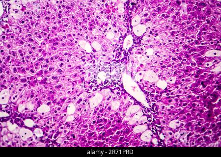 Histopathology of acute hepatitis, light micrograph, photo under ...