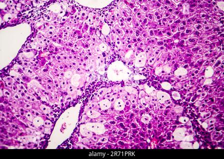 Histopathology of acute hepatitis, light micrograph, photo under ...