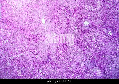 Cloudy swelling of the liver, light micrograph, photo under microscope ...