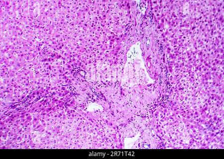 Cloudy swelling of the liver, light micrograph, photo under microscope ...