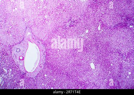 Liver edema, light micrograph, photo under microscope Stock Photo - Alamy
