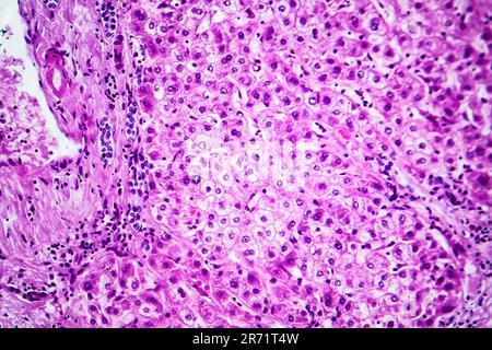 Cloudy swelling of the liver, light micrograph, photo under microscope ...