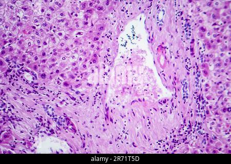 Cloudy swelling of the liver, light micrograph, photo under microscope ...