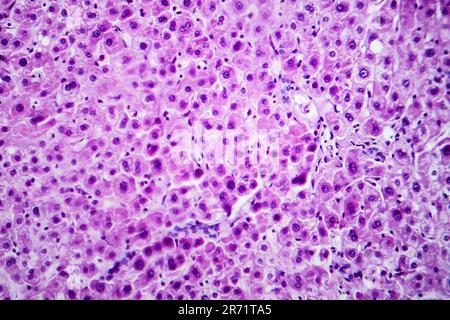 Cloudy swelling of the liver, light micrograph, photo under microscope ...
