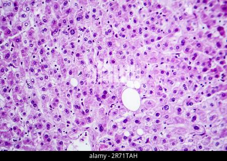 Cloudy swelling of the liver, light micrograph, photo under microscope ...