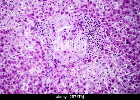Cloudy swelling of the liver, light micrograph, photo under microscope ...
