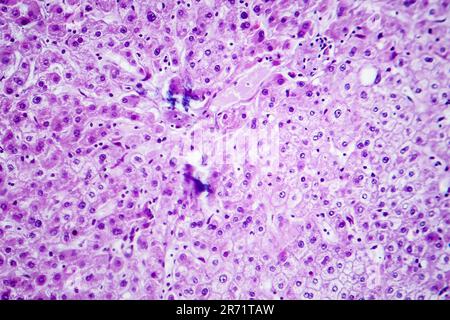 Cloudy swelling of the liver, light micrograph, photo under microscope ...