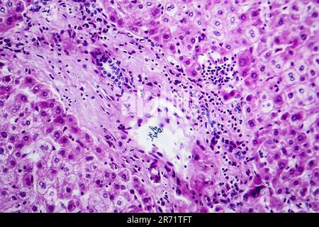 Cloudy swelling of the liver, light micrograph, photo under microscope ...