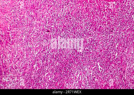 Non-Hodgkin's lymphoma, light micrograph, photo under microscope Stock ...