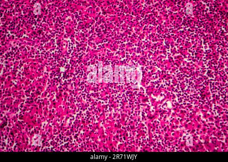 Non-Hodgkin's lymphoma, light micrograph, photo under microscope Stock ...