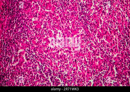 Non-Hodgkin's lymphoma, light micrograph, photo under microscope Stock ...
