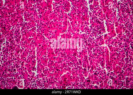 Non-Hodgkin's lymphoma, light micrograph, photo under microscope Stock ...