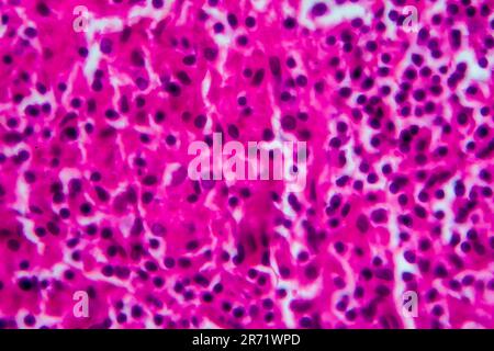 Non-Hodgkin's lymphoma, light micrograph, photo under microscope Stock ...