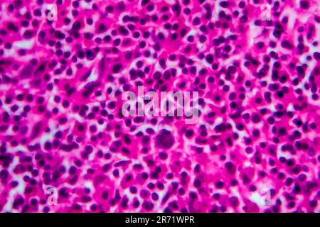 Non-Hodgkin's lymphoma, light micrograph, photo under microscope Stock ...