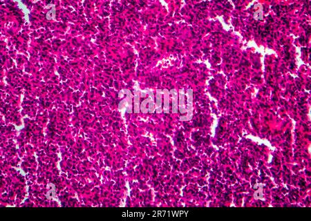 Non-Hodgkin's lymphoma, light micrograph, photo under microscope Stock ...