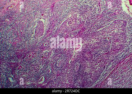 Hodgkin's lymphoma, light micrograph, photo under microscope Stock ...