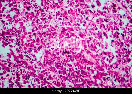 Renal cell carcinoma, light micrograph, photo under microscope Stock ...