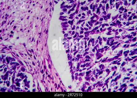 Wilms tumor, or nephroblastoma, light micrograph, photo under ...