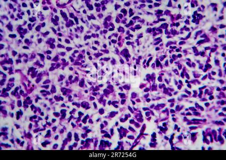 Wilms tumor, or nephroblastoma, light micrograph, photo under ...