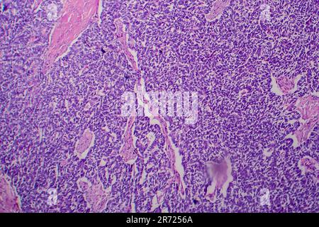 Wilms tumor, or nephroblastoma, light micrograph, photo under ...