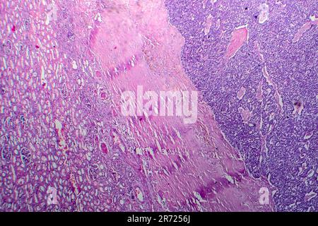 Wilms tumor, or nephroblastoma, light micrograph, photo under ...