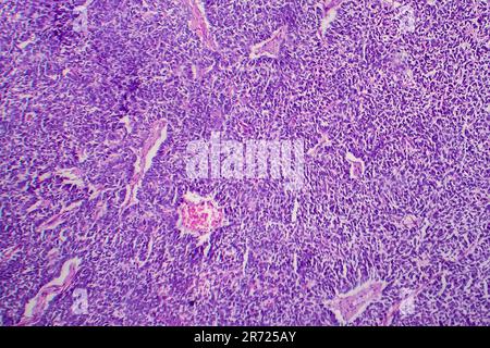Wilms tumor, or nephroblastoma, light micrograph, photo under ...