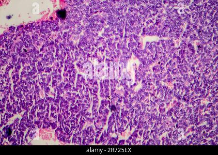 Wilms tumor, or nephroblastoma, light micrograph, photo under ...