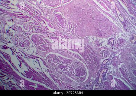 Bladder transitional cell carcinoma, light micrograph, photo under ...