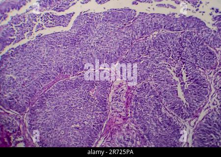 Bladder transitional cell carcinoma, light micrograph, photo under ...