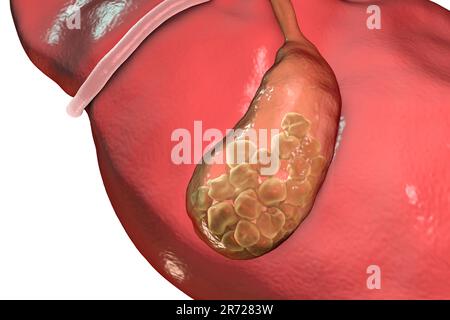 Gallstones. Artwork showing the liver and gallbladder with gallstones ...