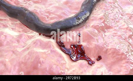 Hemorrhage, blood flowing from the damaged blood vessel, 3D ...