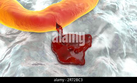 Hemorrhage, blood flowing from the damaged blood vessel, 3D ...