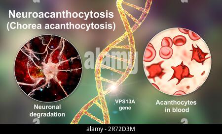 Neuroacanthocytosis, Chorea acanthocytosis, a neurodegenerative disease ...