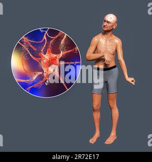 A person with chorea disease and close-up view of neuronal degradation ...
